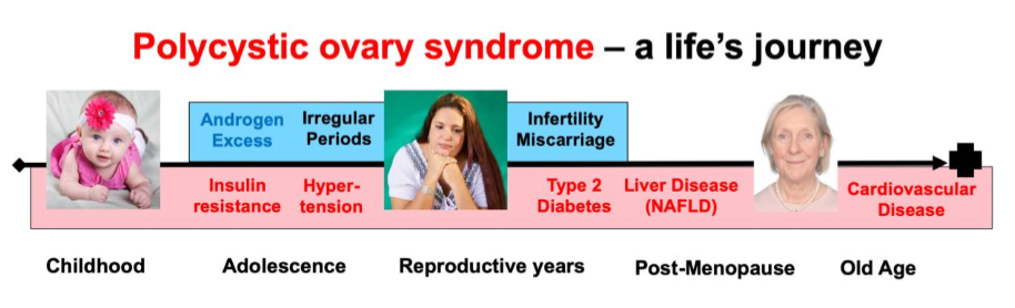 What is Polycystic ovary syndrome (PCOS)? – DAISy-PCOS
